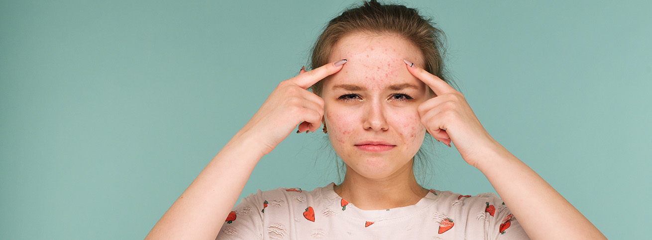 Does Vaping Cause Acne? A Look At The Science | Triton Sensors